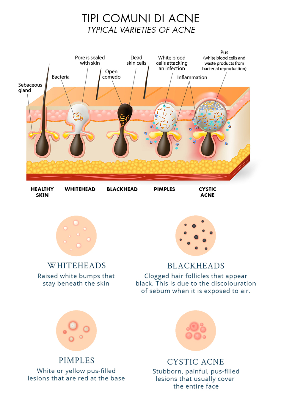 The OLEO Series: Your Ultimate Acne-Fighting Solution | MILLABEL